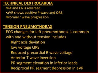 Significance of avR lead | PPT