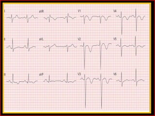 Significance of avR lead | PPT
