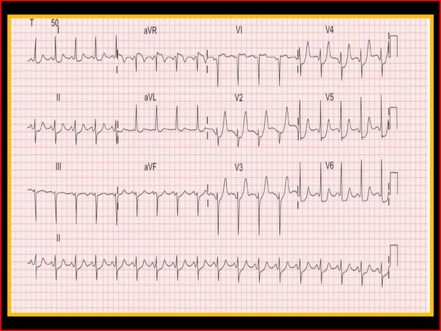 Significance of avR lead | PPT