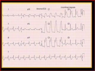 Significance of avR lead | PPTX