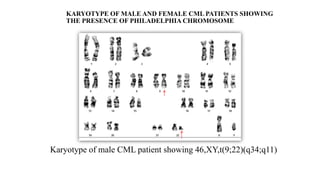 CHRONIC MYELOID LEUKEMIA | PPT