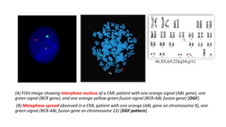 CHRONIC MYELOID LEUKEMIA | PPT