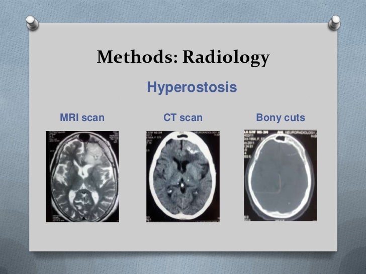 Significance of hyperostosis in meningiomas