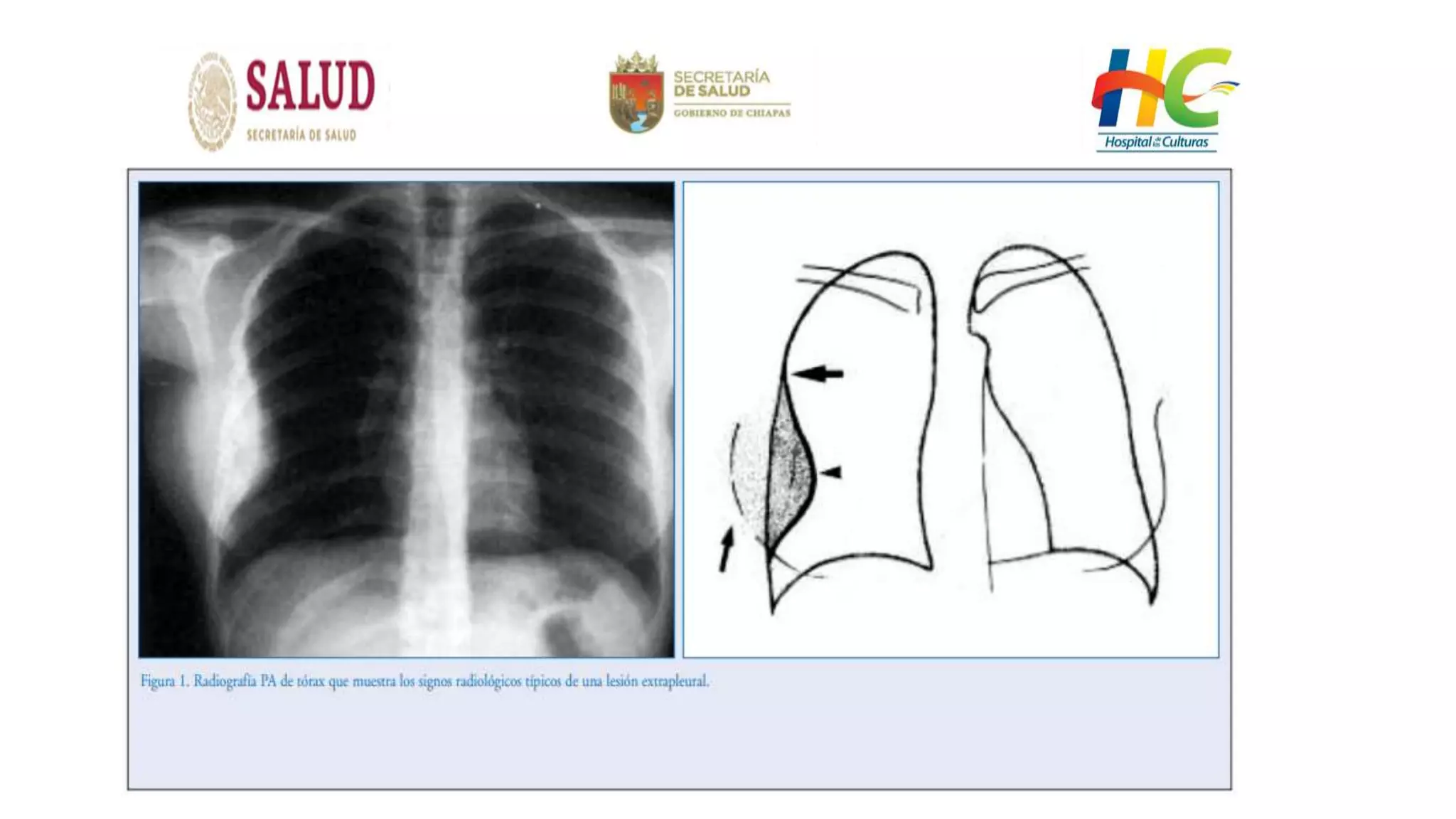 SIGNO DE LA OCULTACION HILIAR.pptx
