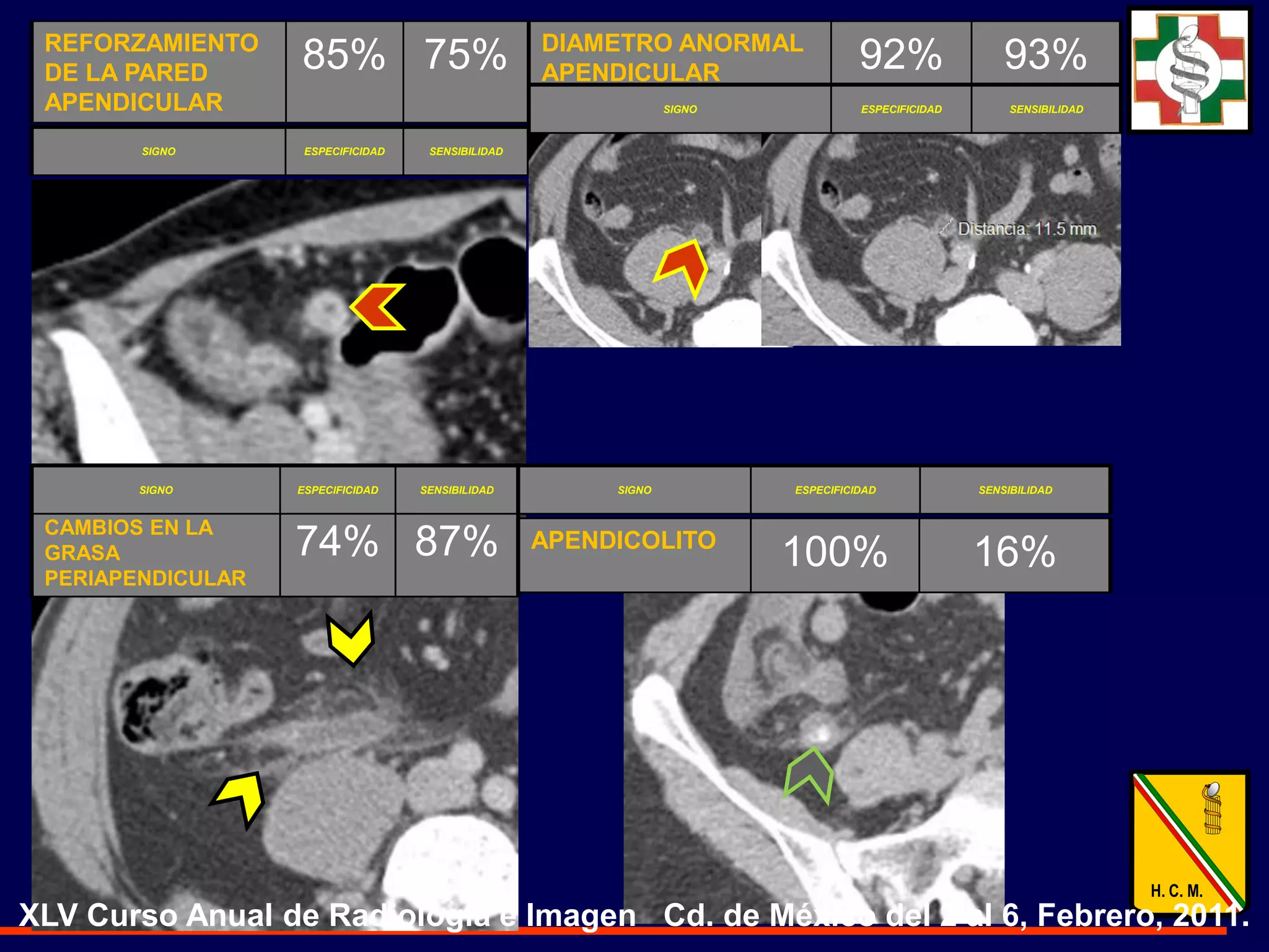 Signologia apendicitis aguda por TC | PPT