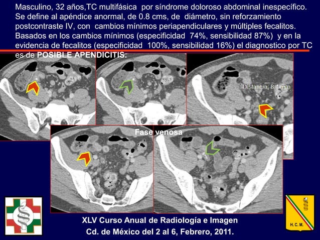 Signologia apendicitis aguda por TC | PDF
