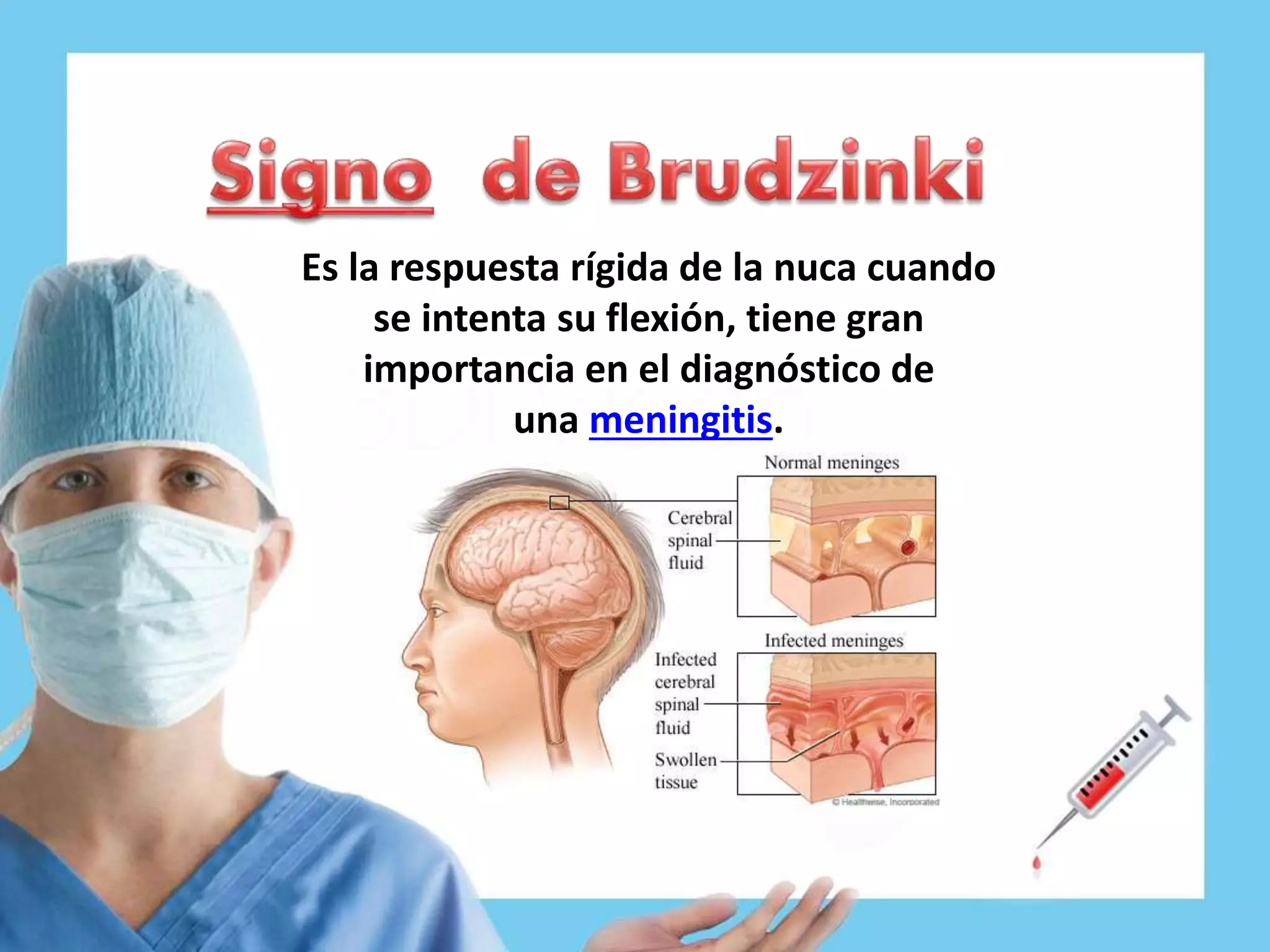 Signo de Brudzinski y de Kerning - Elyz A. Cortez López | PPTX