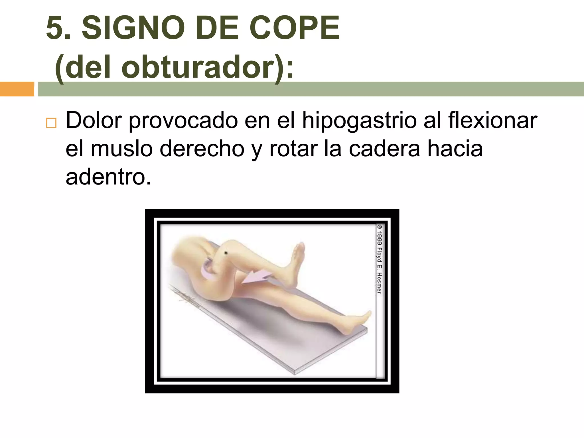 Signos clinicos de apendicitis | PPTX