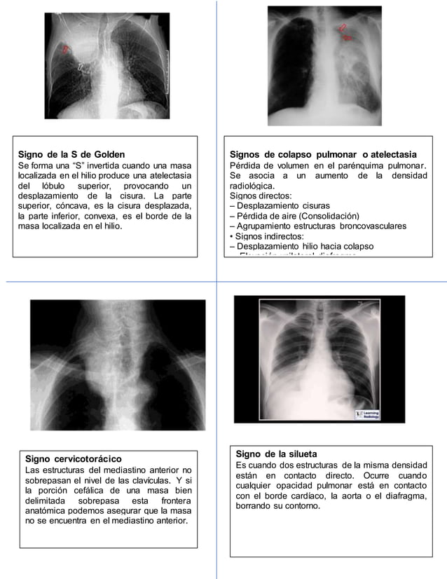 Signos radiológicos de tórax