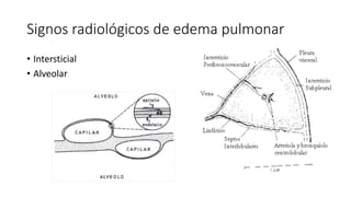 Signos radiológicos de edema pulmonar | PPTX