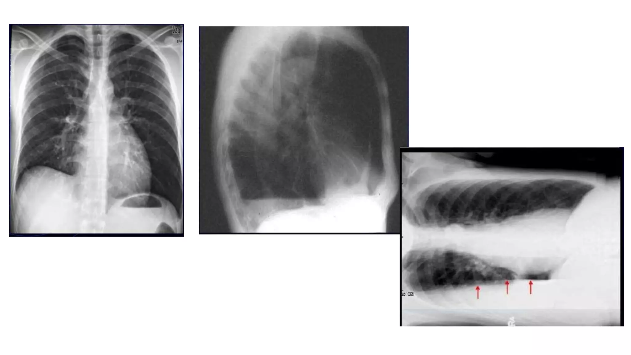 Signos radiológicos del derrame pleural | PPTX