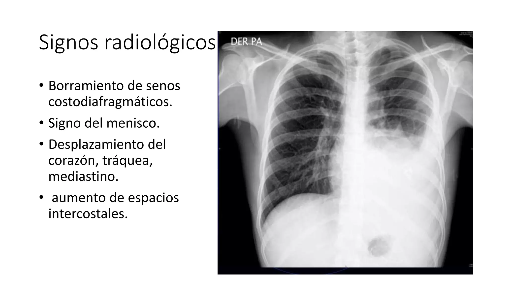 Signos radiológicos del derrame pleural | PPT