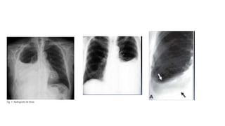 Signos radiológicos del derrame pleural | PPTX