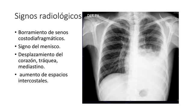 Signos radiológicos del derrame pleural