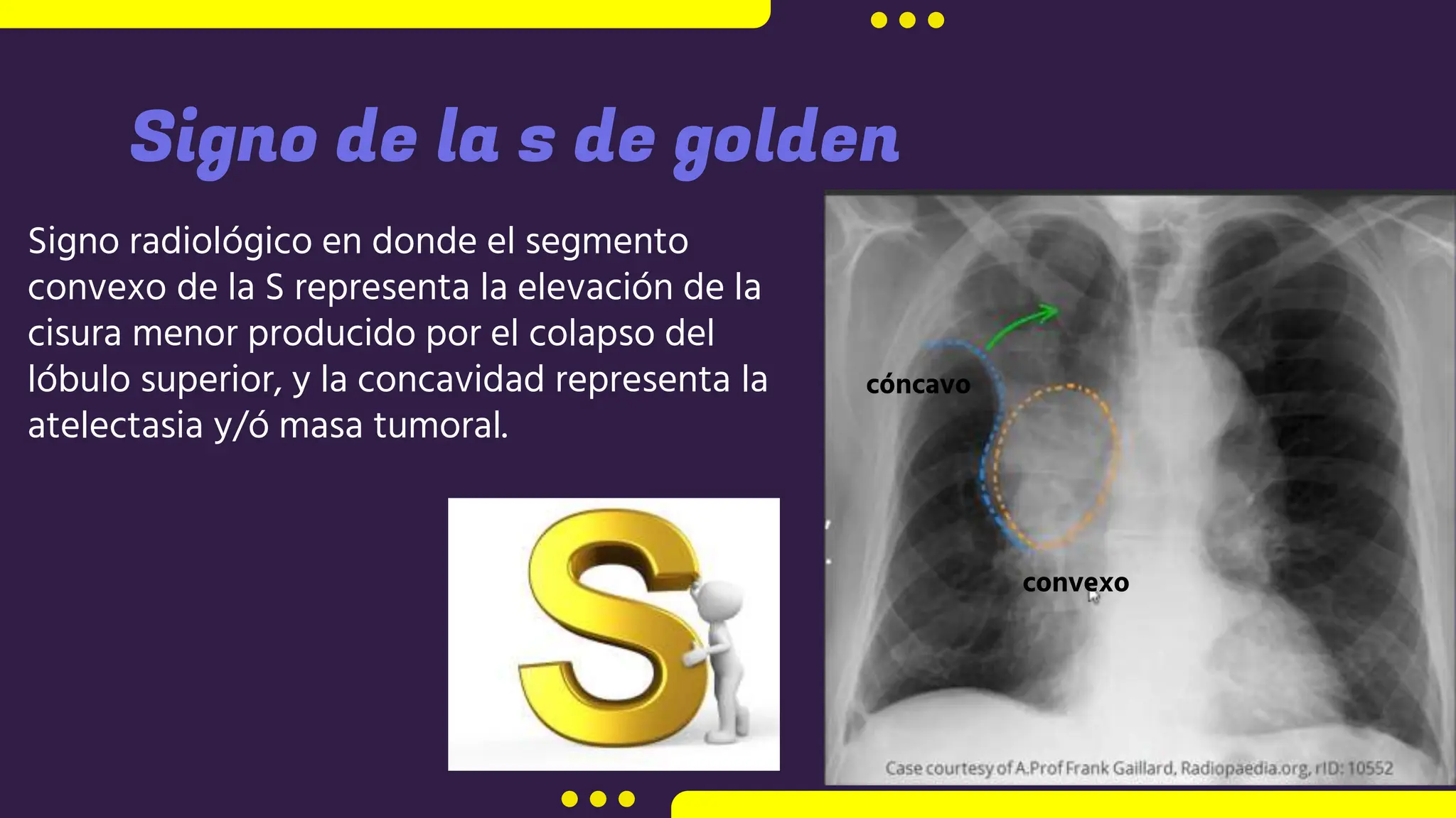 Signos radiológicos en las radiografías de tórax | PPTX | Lung and ...