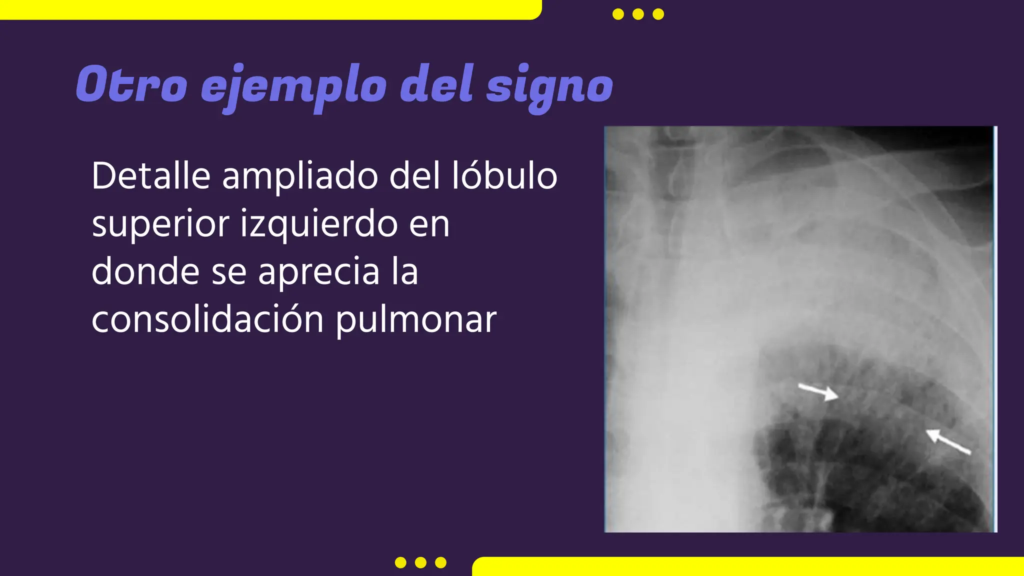 Signos radiológicos en las radiografías de tórax | PPTX | Lung and ...