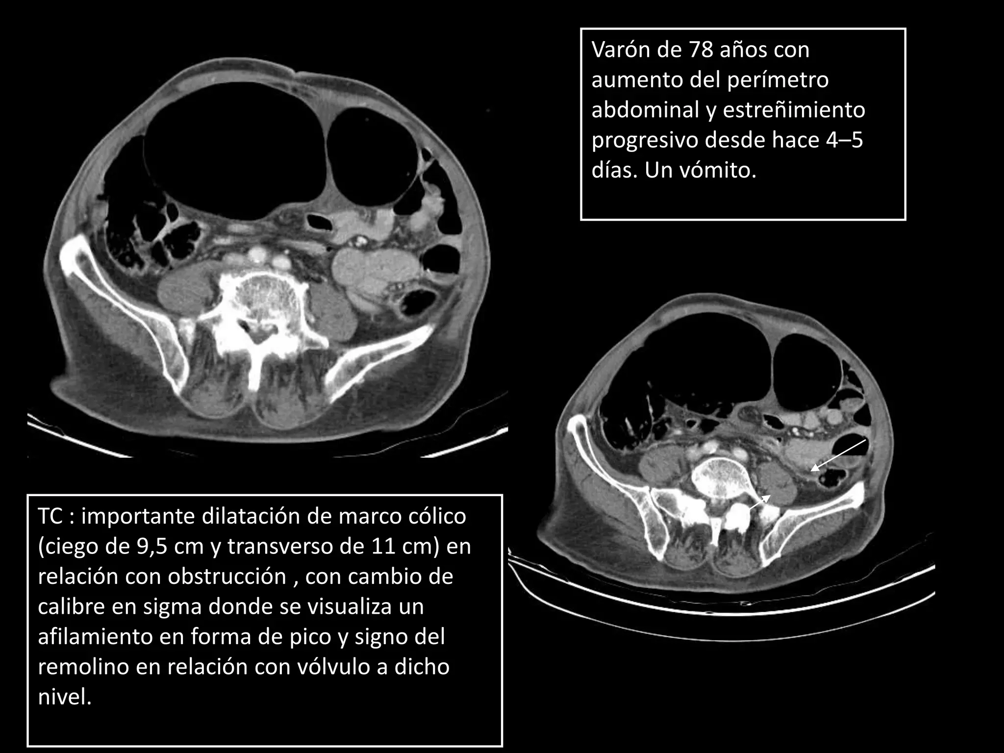 Signos Radiologicos en TC de Abdomen Agudo | PDF | Digestive Disorders ...