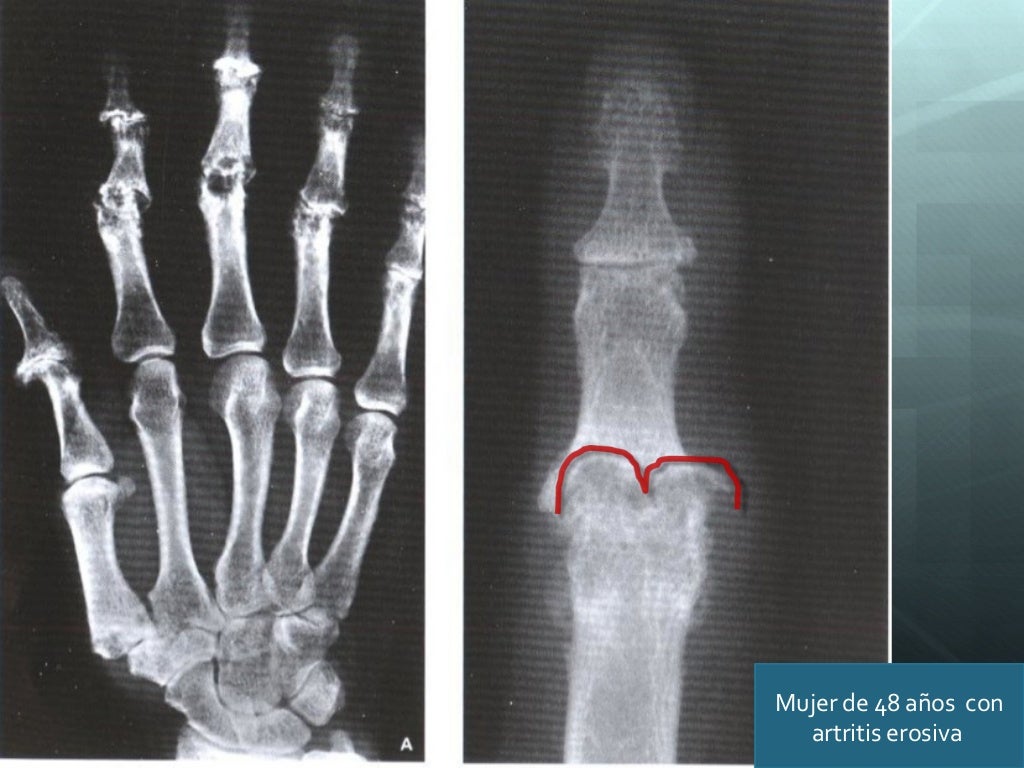Signos radiologicos de artritis