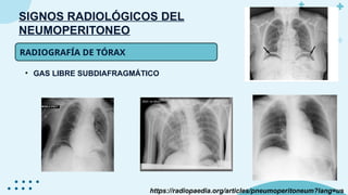 SIGNOS RADIOLOGICOS DEL NEUMOPERITONEO.pptx