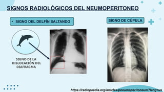 SIGNOS RADIOLOGICOS DEL NEUMOPERITONEO.pptx