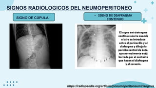 SIGNOS RADIOLOGICOS DEL NEUMOPERITONEO.pptx
