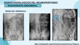 SIGNOS RADIOLOGICOS DEL NEUMOPERITONEO.pptx