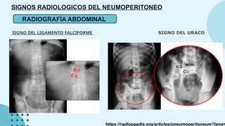 SIGNOS RADIOLOGICOS DEL NEUMOPERITONEO.pptx