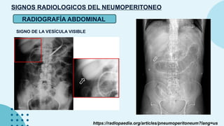 SIGNOS RADIOLOGICOS DEL NEUMOPERITONEO.pptx