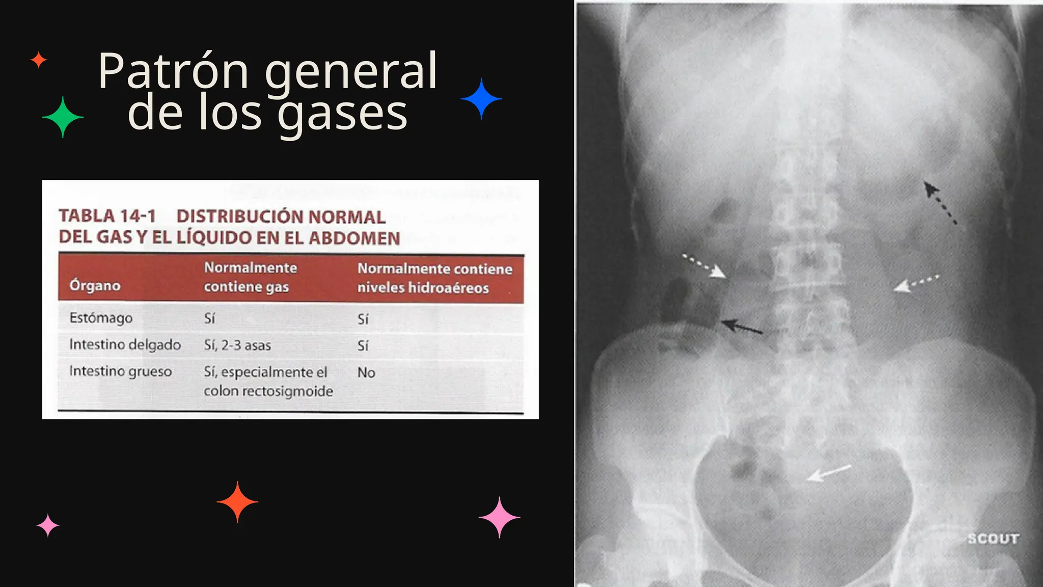 Signos radiológicos de abdomen presentación.pptx