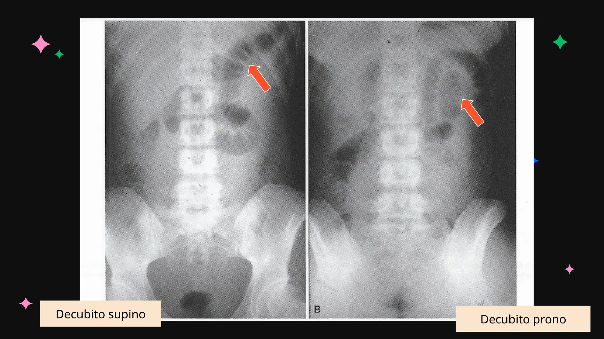 Signos radiológicos de abdomen presentación.pptx