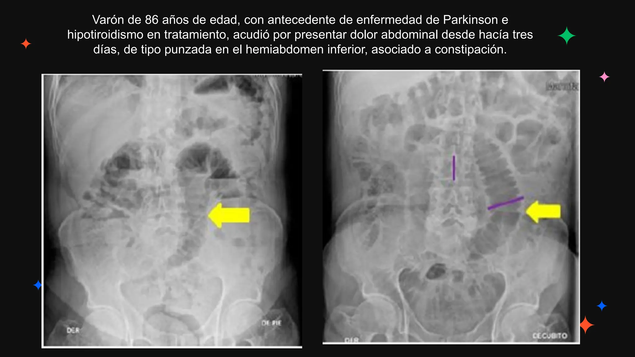 Signos radiológicos de abdomen presentación.pptx