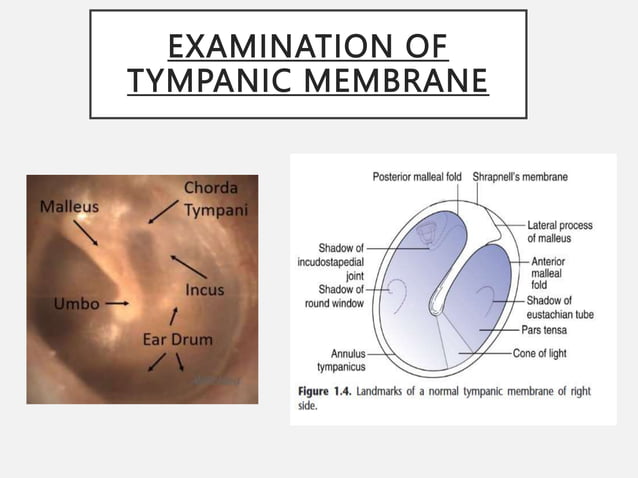 Signs and Examination of Chronic Suppurative Otitis Media | PPT