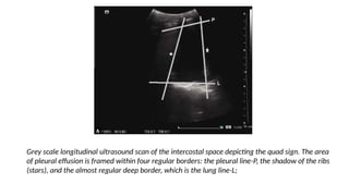 Signs and lines in usg thorax.pptx radiolgy | PPTX