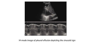 Signs and lines in usg thorax.pptx radiolgy | PPTX