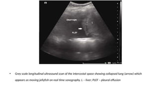Signs and lines in usg thorax.pptx radiolgy | PPTX