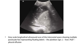 Signs and lines in usg thorax.pptx radiolgy | PPTX