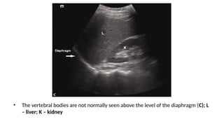 Signs and lines in usg thorax.pptx radiolgy | PPTX