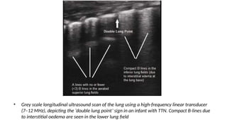Signs and lines in usg thorax.pptx radiolgy | PPTX