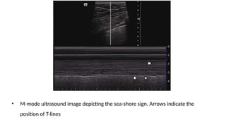 Signs and lines in usg thorax.pptx radiolgy | PPTX