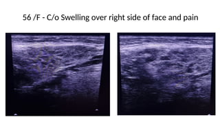 Signs and lines in usg thorax.pptx radiolgy | PPTX