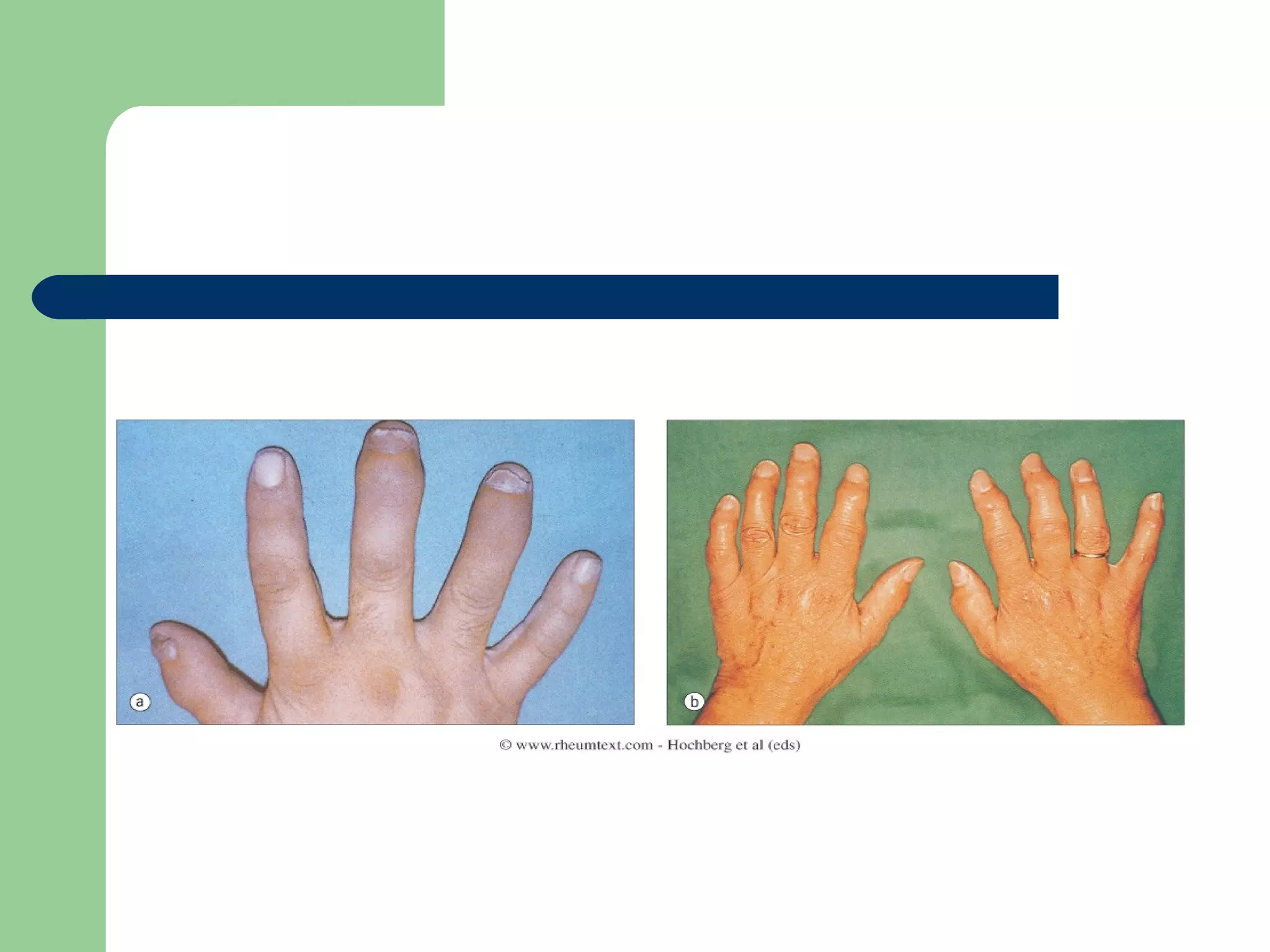 Signs and symptoms in rheumatology | PPT