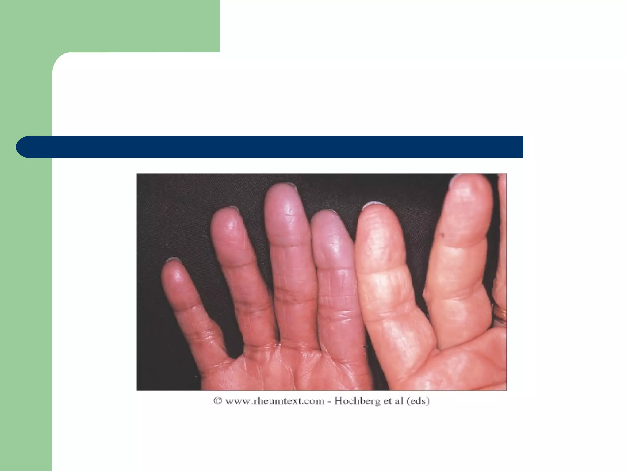 Signs and symptoms in rheumatology | PPT