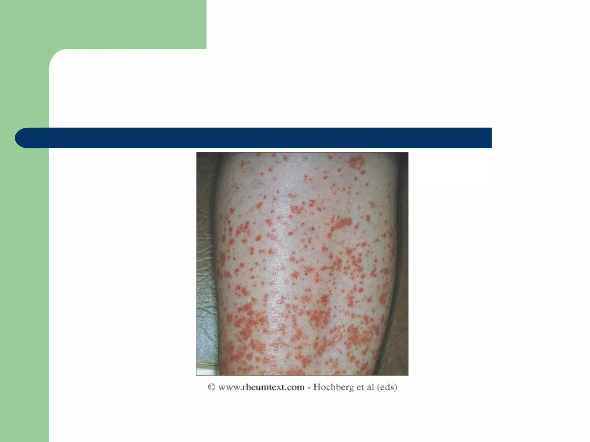 Signs and symptoms in rheumatology | PPT