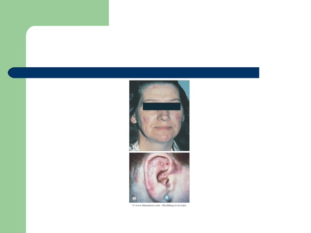 Signs and symptoms in rheumatology | PPT