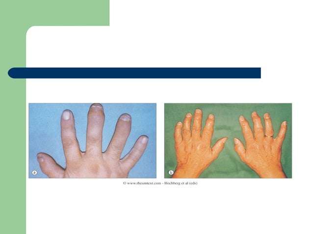 Signs and symptoms in rheumatology | PPT