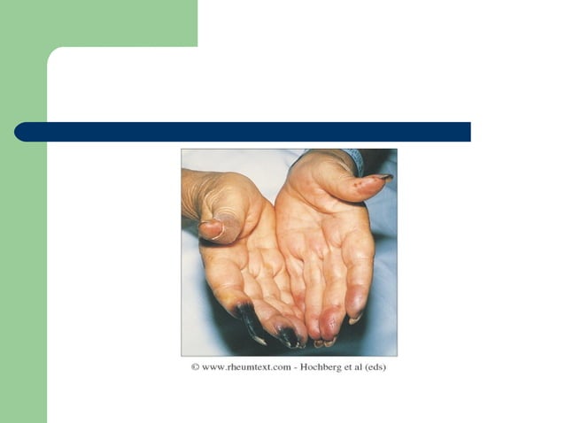 Signs and symptoms in rheumatology | PPT