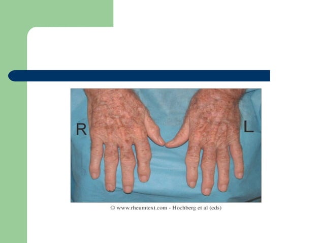 Signs and symptoms in rheumatology | PPT