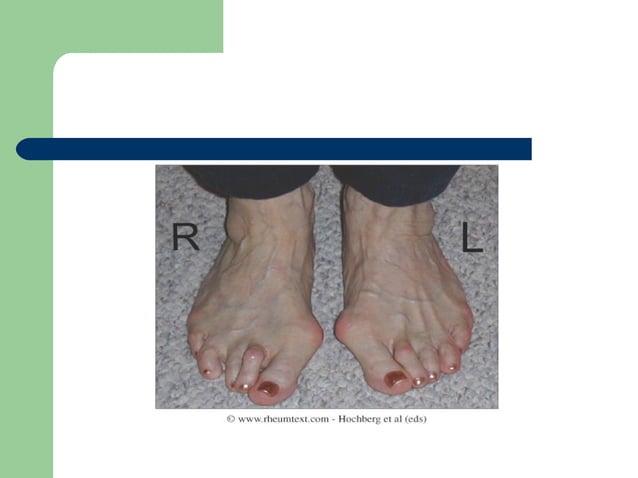 Signs and symptoms in rheumatology | PPT