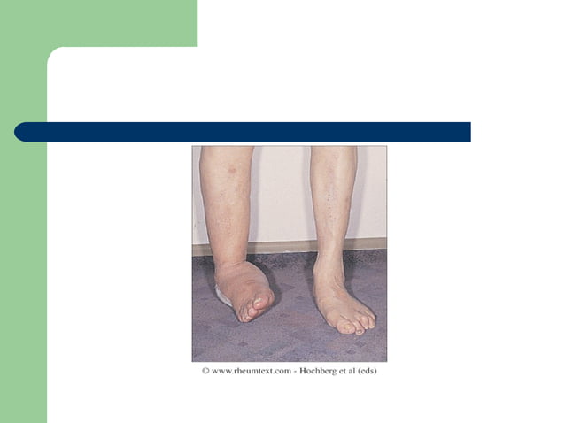 Signs and symptoms in rheumatology | PPT