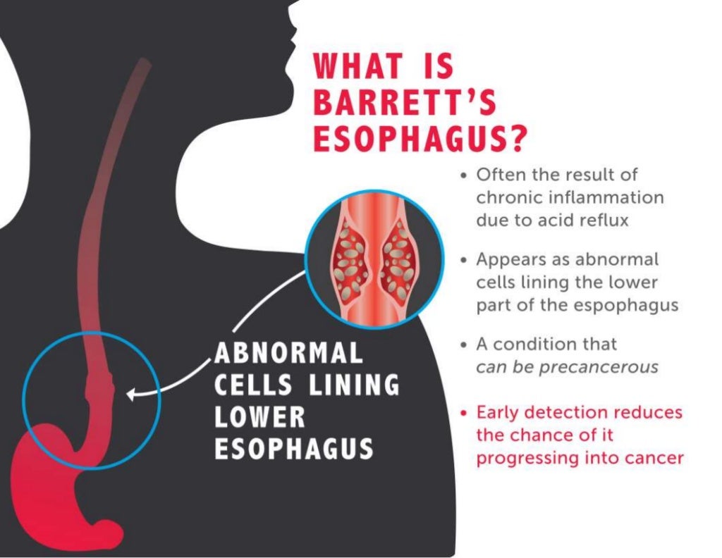Esophageal Cancer Types Stages Symptoms Causes Diagno - vrogue.co Esophageal Cancer Types Stages Symptoms Causes Diagno - vrogue.co